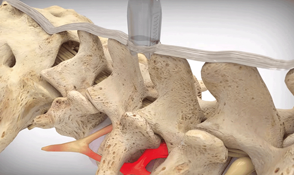 Vertiflex Procedure | Pain Management | Georgetown, KY